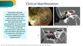 External Cholesteatoma in the ear literature reading | PPTX