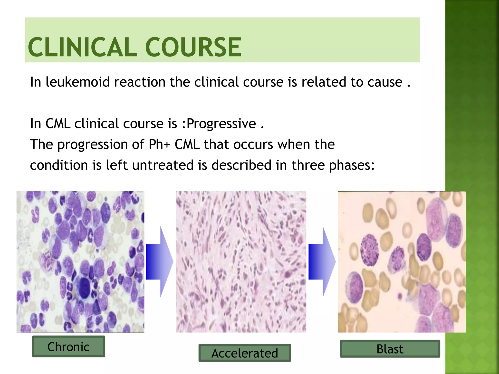 leukemoid reaction and leukemia | PPTX