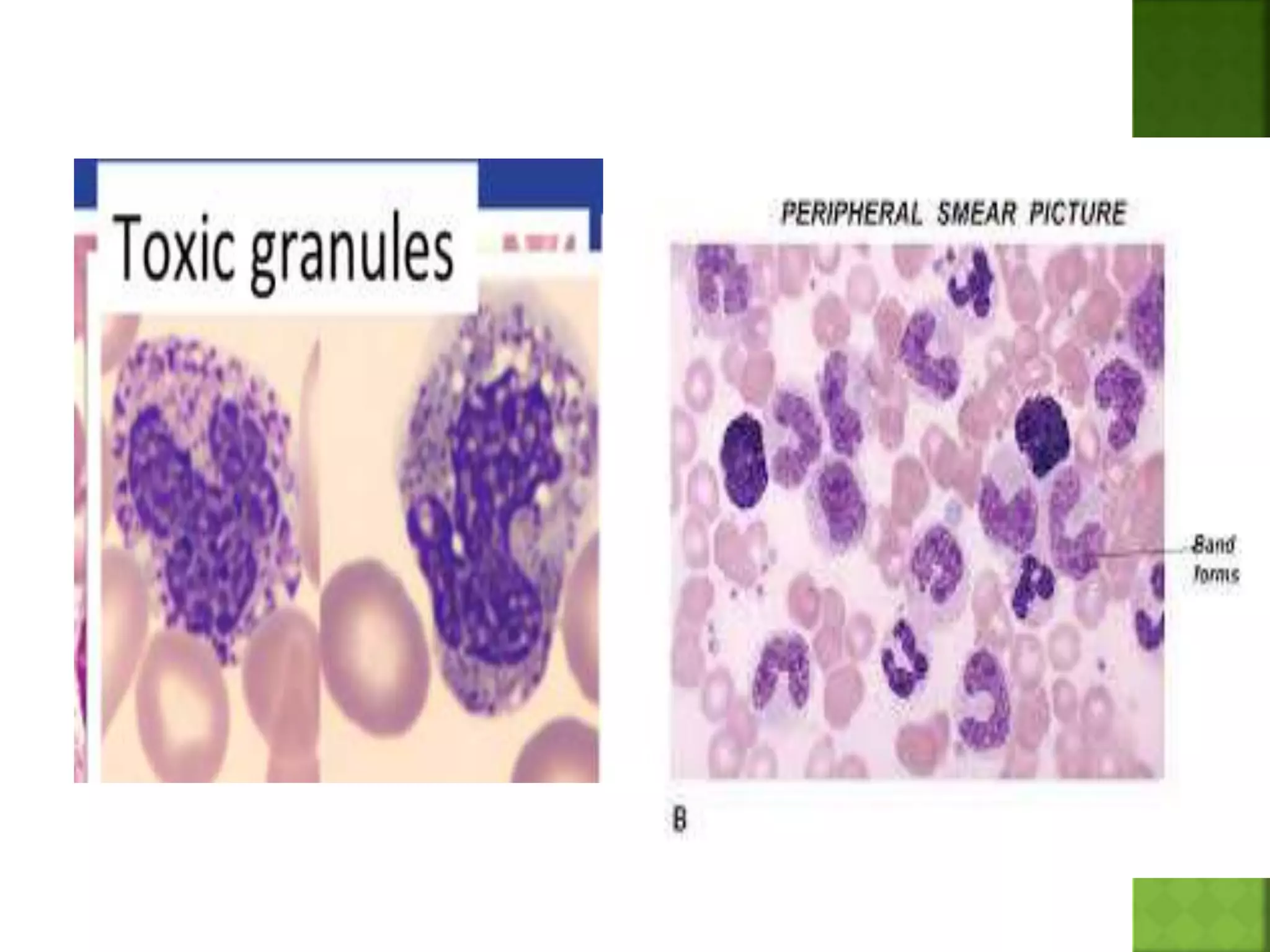leukemoid reaction and leukemia | PPTX