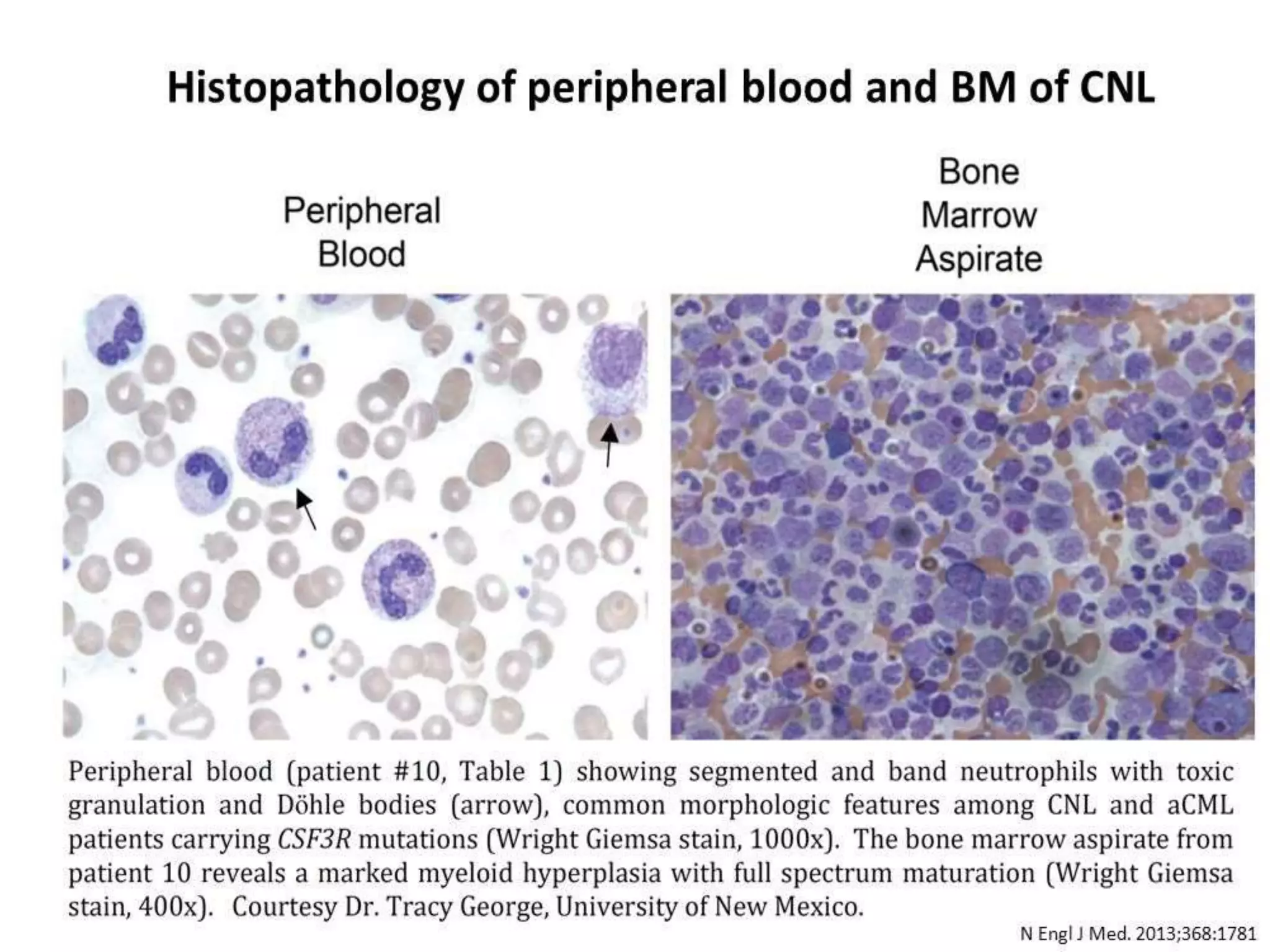 leukemoid reaction and leukemia | PPTX