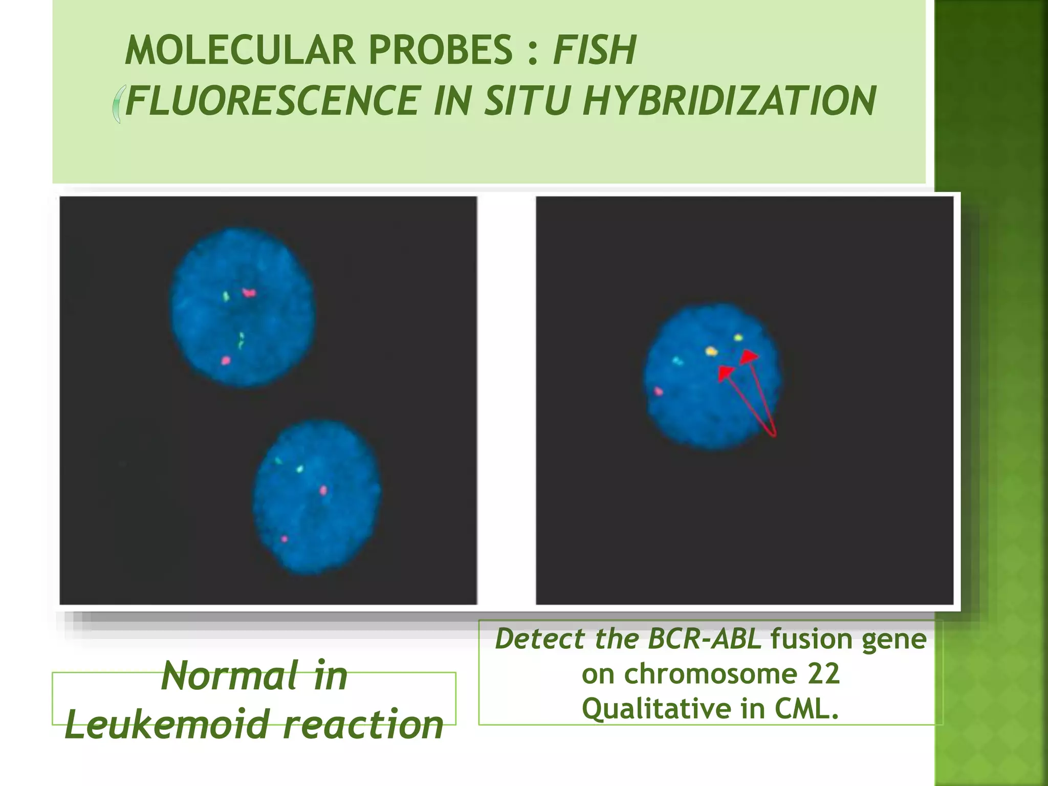 leukemoid reaction and leukemia | PPTX