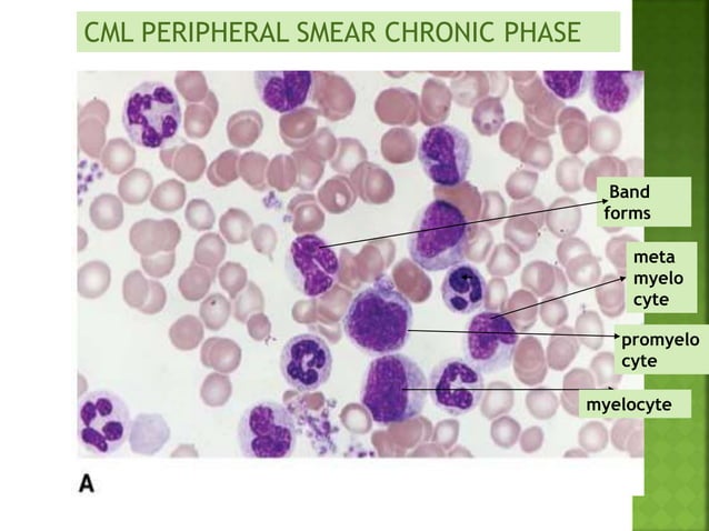 leukemoid reaction and leukemia | PPT | Free Download