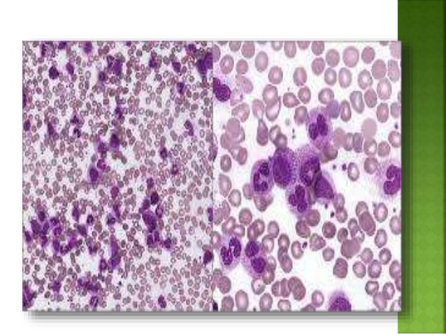 leukemoid reaction and leukemia