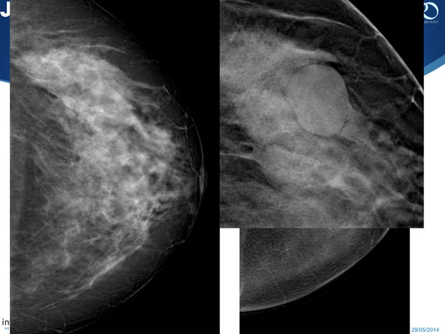 Luc Rotenberg : Digital Breast Tomosynthesis | PPT