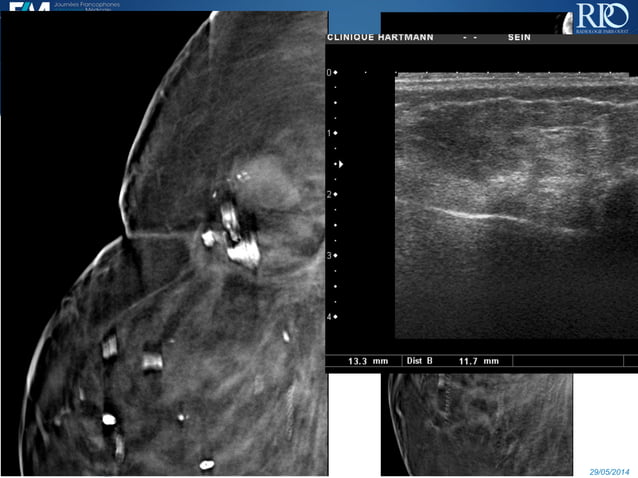 Luc Rotenberg : Digital Breast Tomosynthesis | PPT