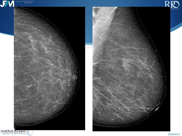 Luc Rotenberg : Digital Breast Tomosynthesis | PPT