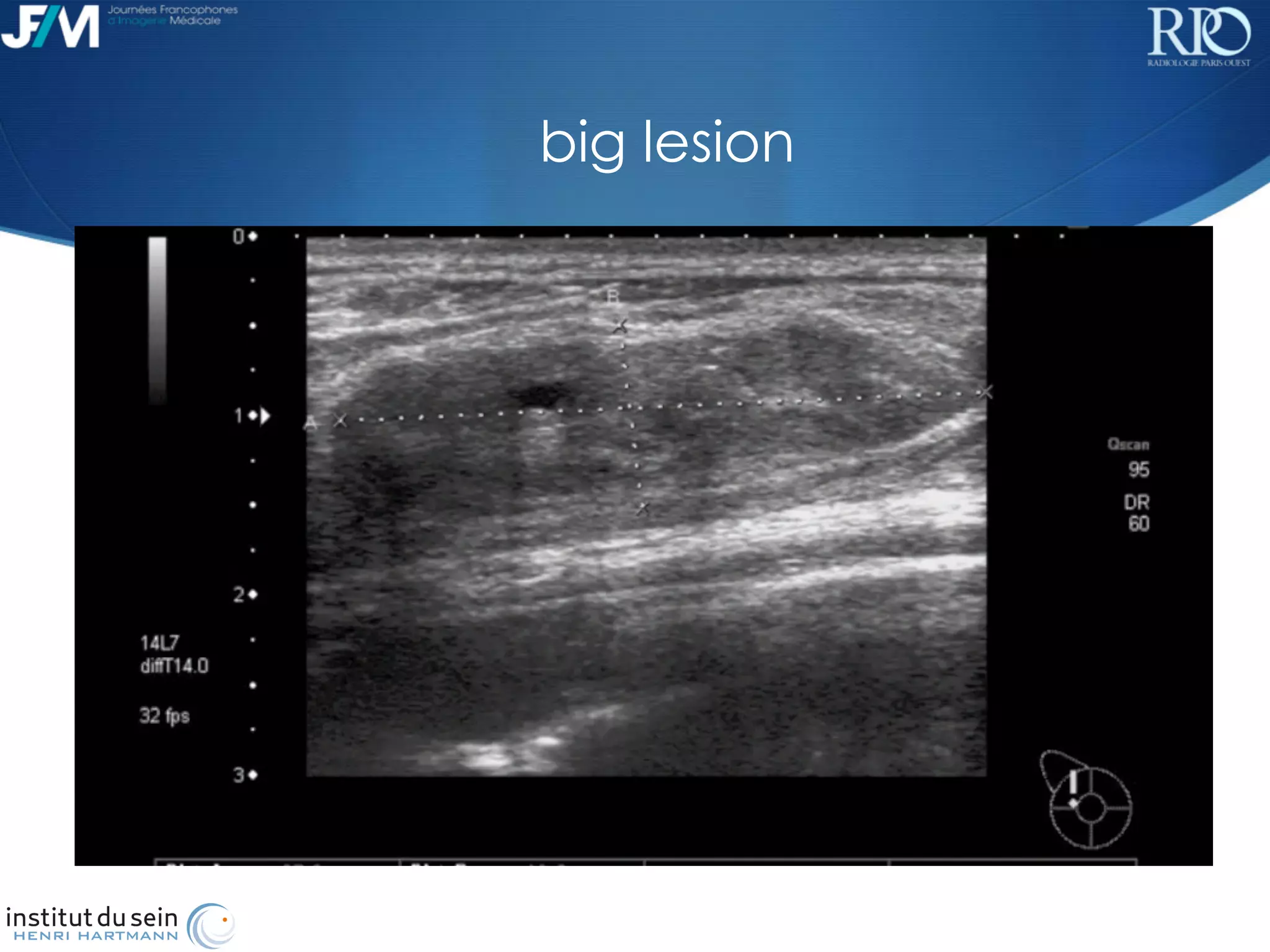 Luc Rotenberg : US guided vacuum breast biopsy and minimal Invasive ...