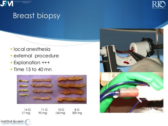 Luc Rotenberg Us Guided Vacuum Breast Biopsy And Minimal Invasive I…
