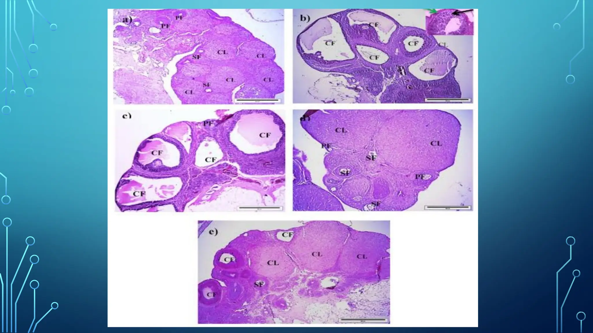 PCOS POLYCYSTIC OVARIAN SYNDROME- ETIOLOGY, PATHOLOGY, HISTOLOGY ...