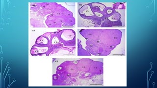 PCOS POLYCYSTIC OVARIAN SYNDROME- ETIOLOGY, PATHOLOGY, HISTOLOGY ...