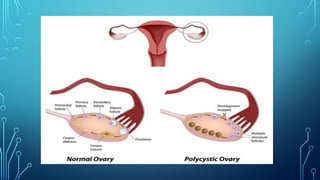 PCOS POLYCYSTIC OVARIAN SYNDROME- ETIOLOGY, PATHOLOGY, HISTOLOGY ...