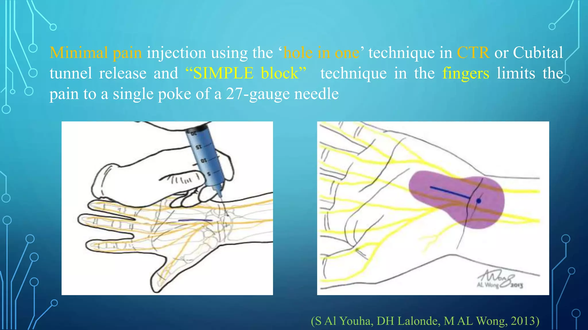 WALANT -Wide Awake Local Anesthesia No Tourniquet Surgery Technique | PPTX