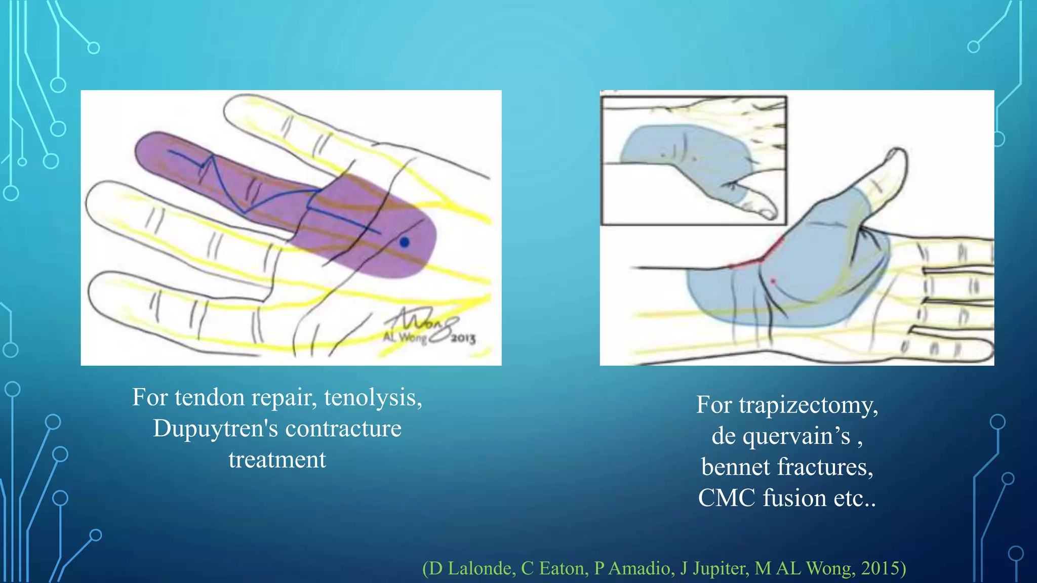 WALANT -Wide Awake Local Anesthesia No Tourniquet Surgery Technique | PPTX