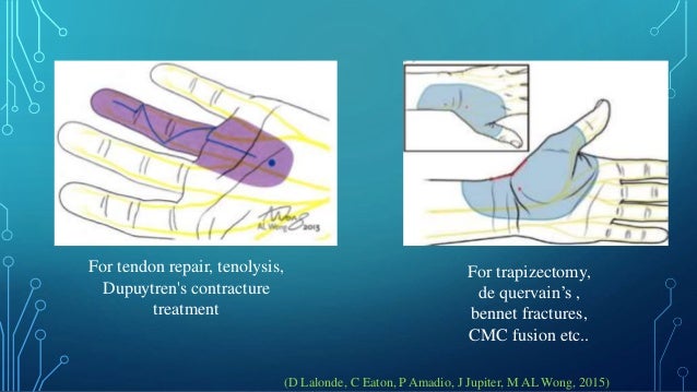 WALANT -Wide Awake Local Anesthesia No Tourniquet Surgery Technique