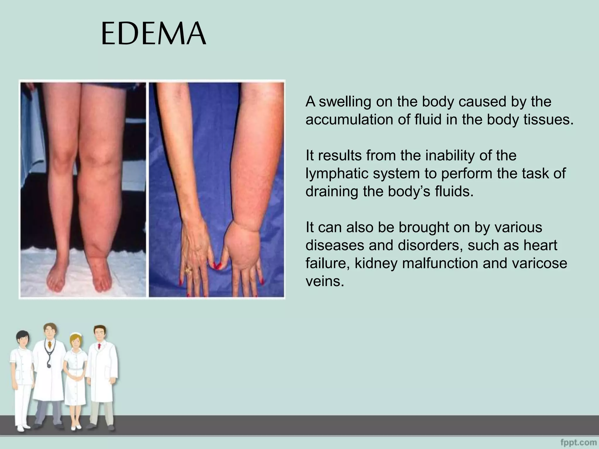 LS 2 9 The Lymphatic System | PPTX