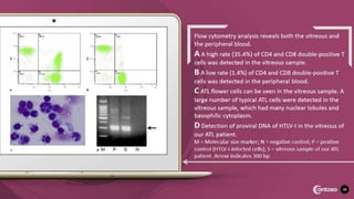 Leukemic stem cell and ATLL | PPTX