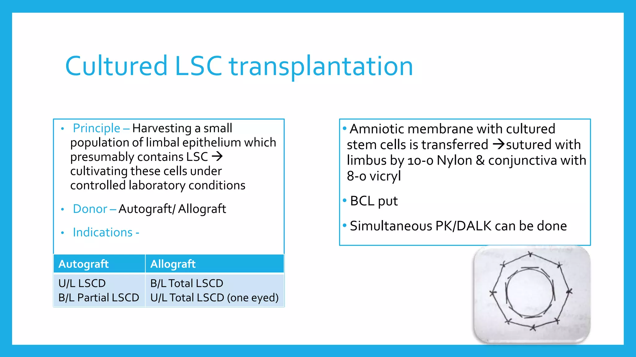 Limbal Stem Cell Deficiency & its management | PPTX
