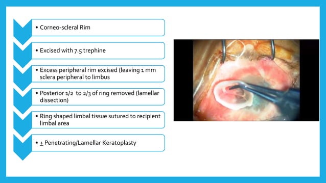 Limbal Stem Cell Deficiency & its management | PPTX
