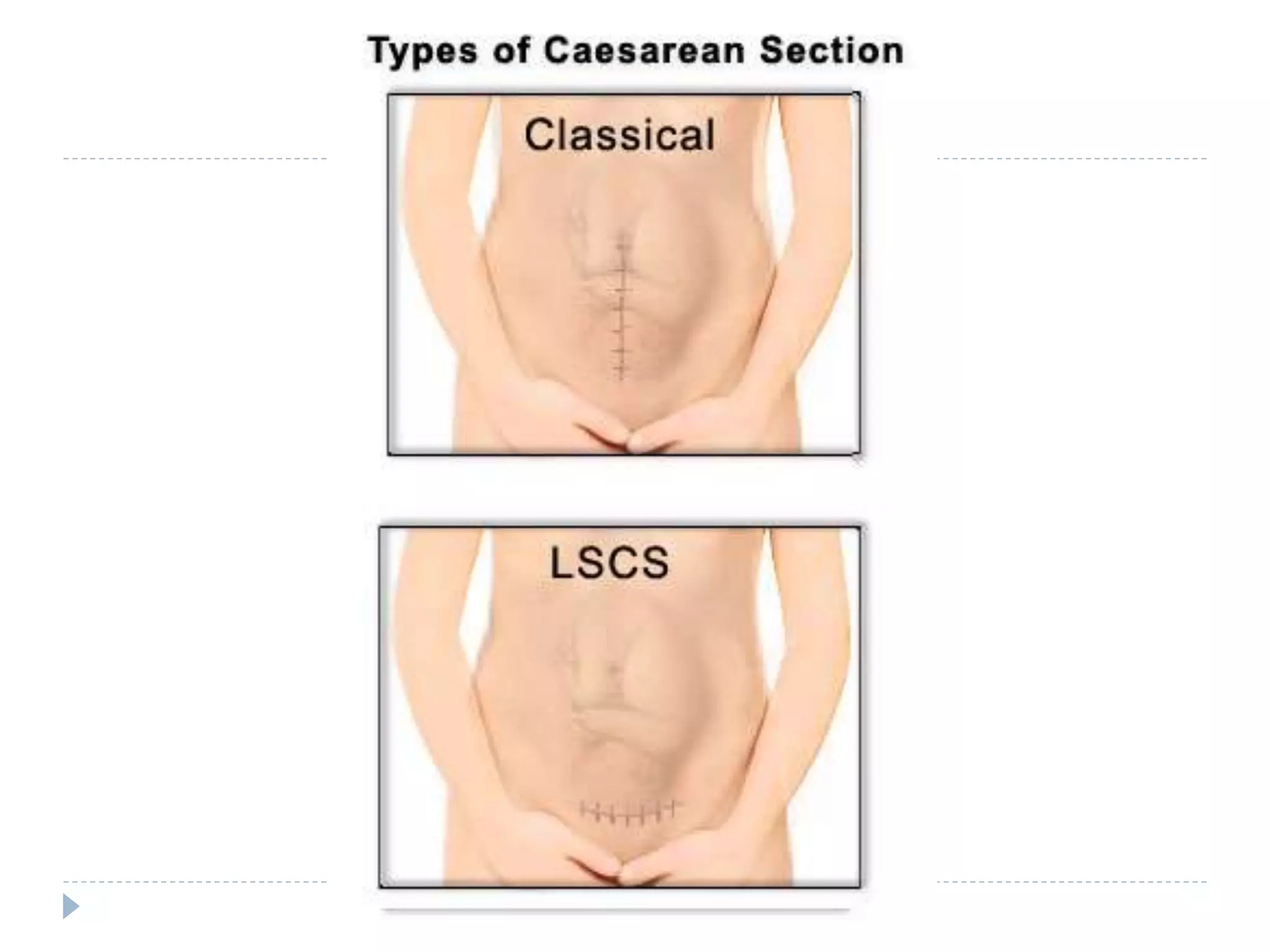 LSCS | PPTX | Pregnancy | Reproductive Health