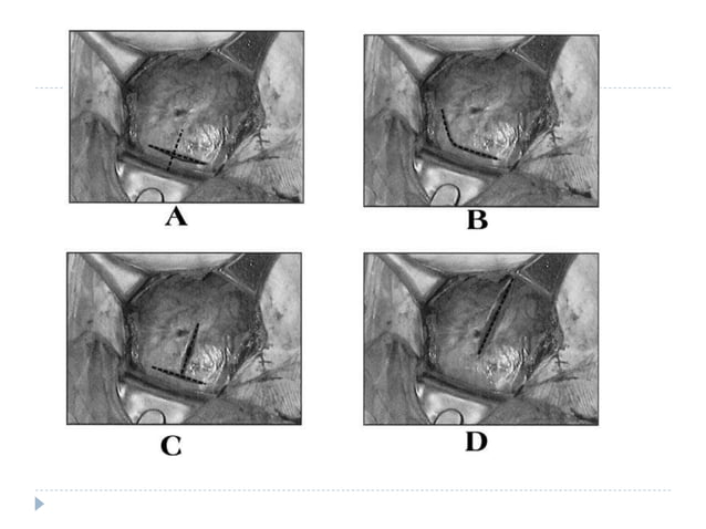 LSCS | PPTX | Pregnancy | Reproductive Health