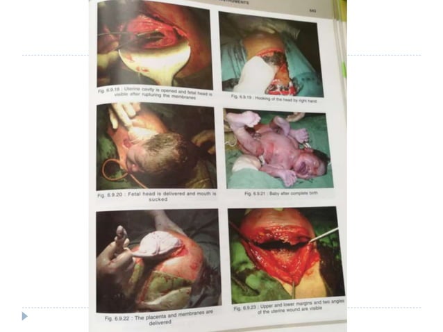 LSCS | PPTX | Pregnancy | Reproductive Health