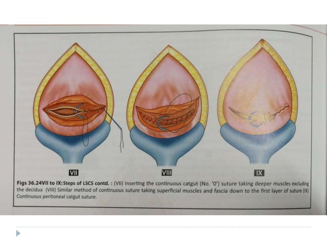LSCS | PPTX | Pregnancy | Reproductive Health