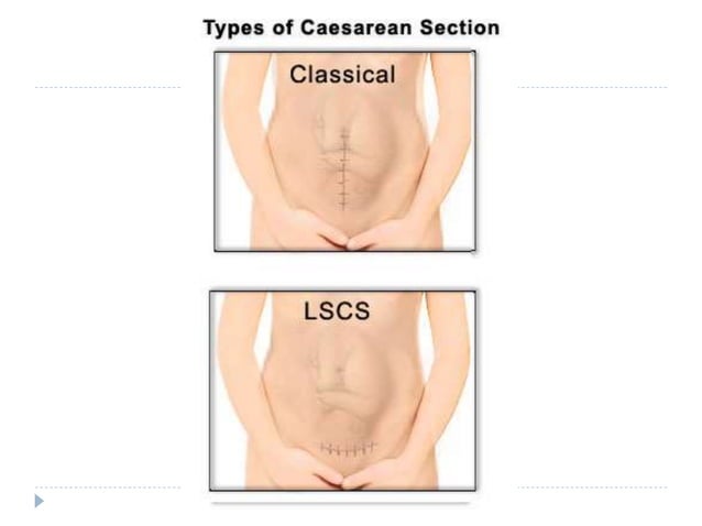 LSCS | PPTX | Pregnancy | Reproductive Health