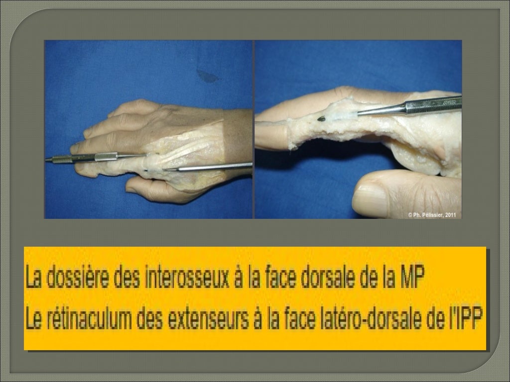 Lésion Des Tendons Extenseurs , REPARATION DES TENDONS EXTENSEURS DES ...