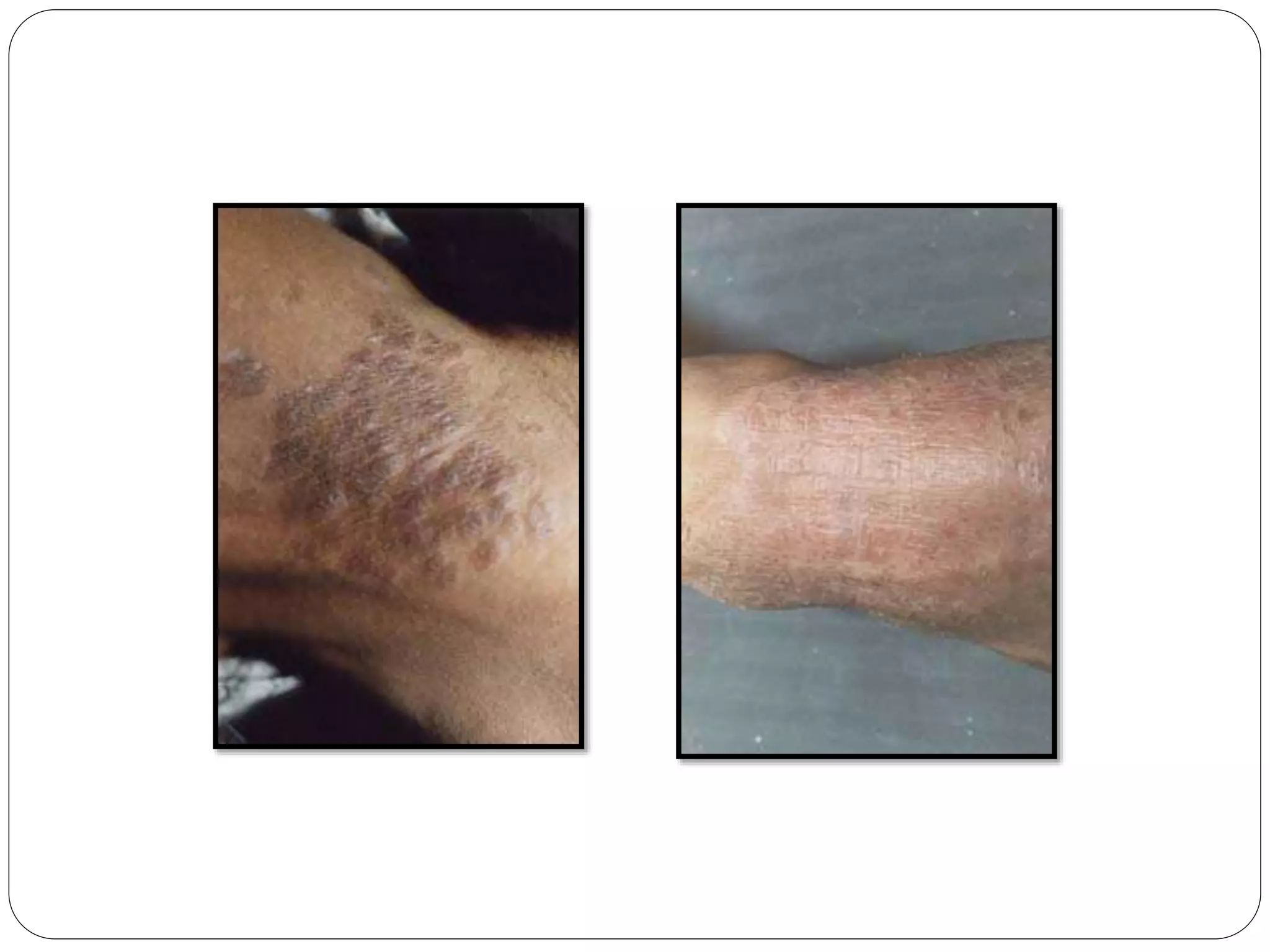 Liken Simpleks Kronis (Neurodermatitis Sirkumskripta) | PPTX