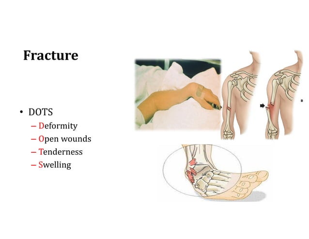 Lecture 7: first aid, choke, CPR, diabetes, bleed, burn | PPT