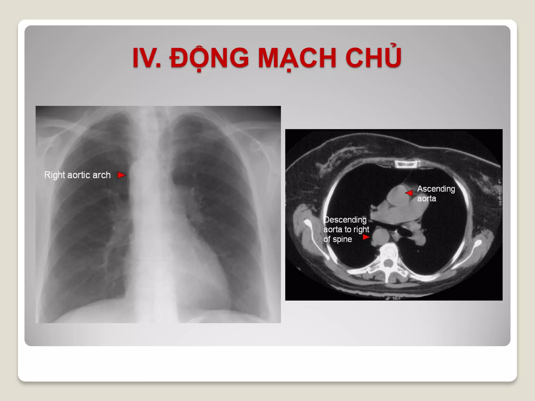 X QUANG TIM BẨM SINH | PDF