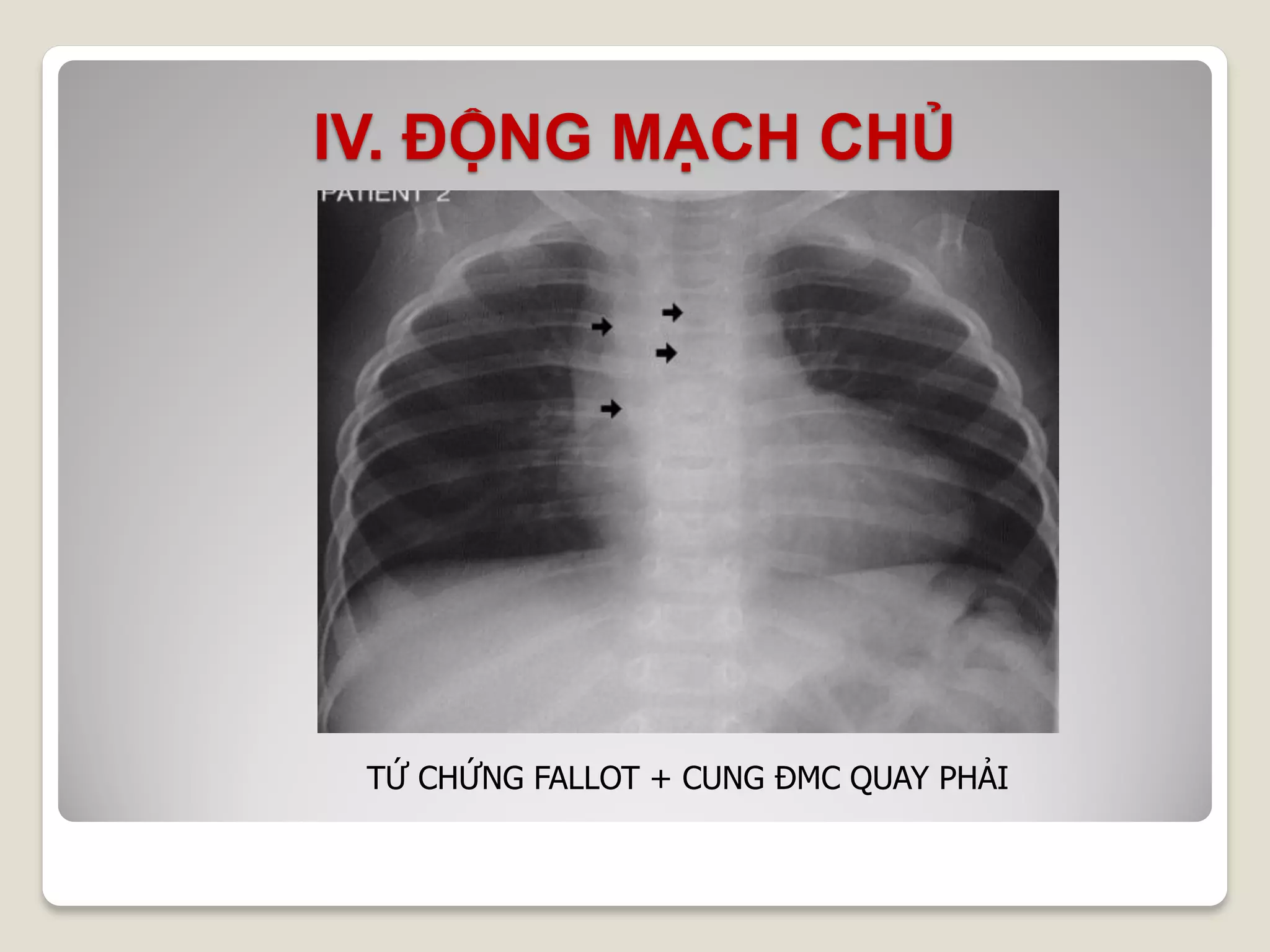 X QUANG TIM BẨM SINH | PDF