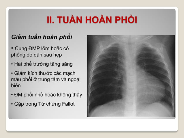 X QUANG TIM BẨM SINH | PDF