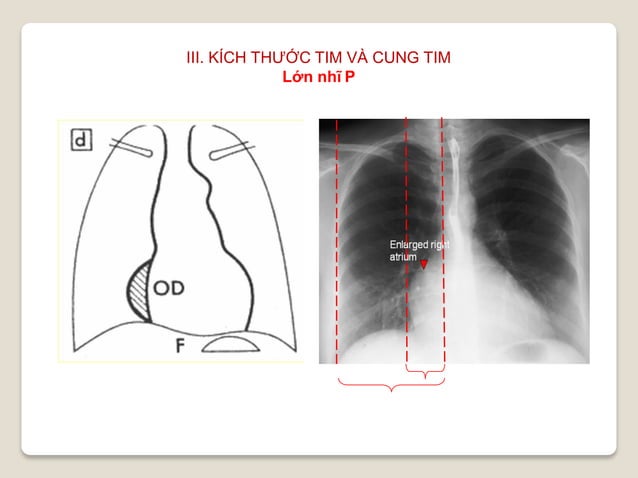 X QUANG TIM BẨM SINH | PDF