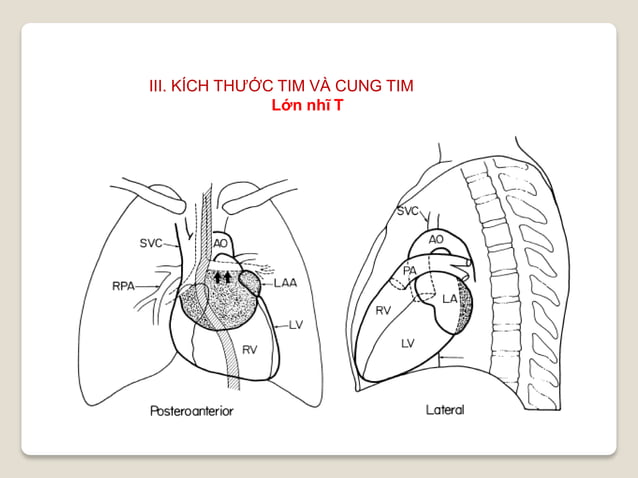 X QUANG TIM BẨM SINH | PDF