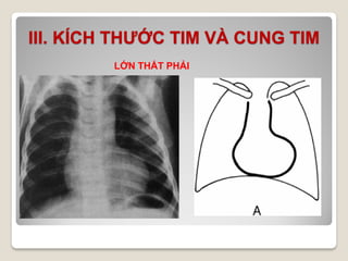 X QUANG TIM BẨM SINH | PDF