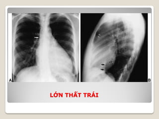 X QUANG TIM BẨM SINH | PDF