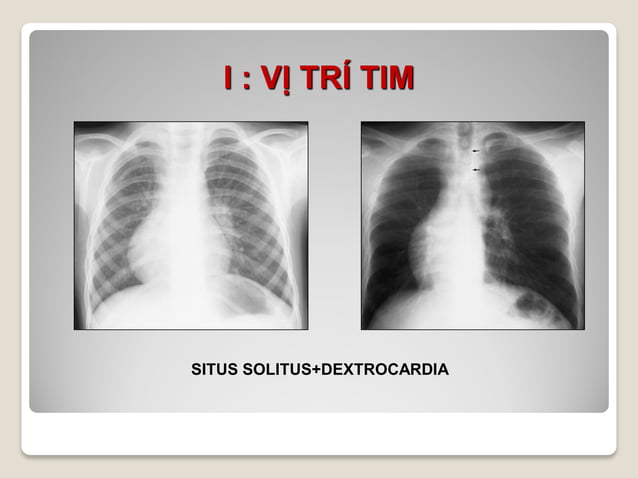 X QUANG TIM BẨM SINH | PDF
