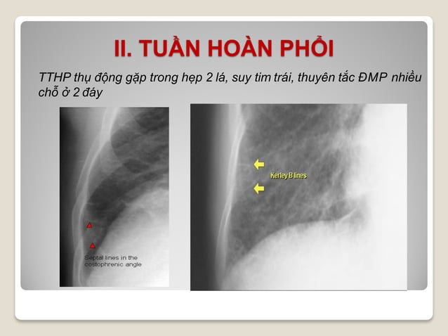 X QUANG TIM BẨM SINH | PDF