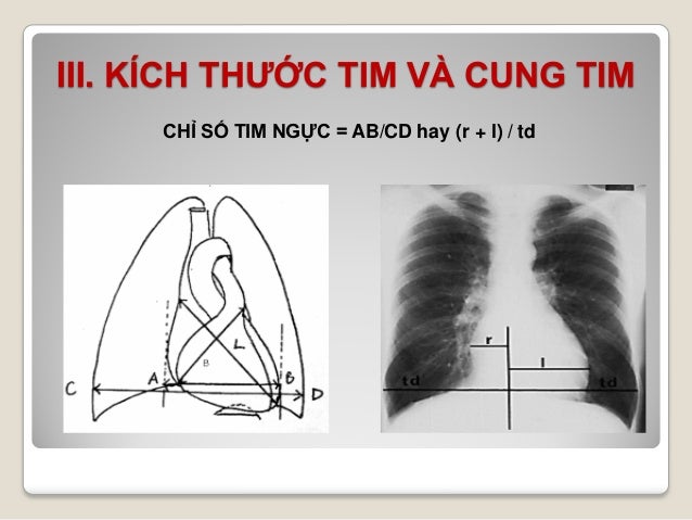 X QUANG TIM BẨM SINH