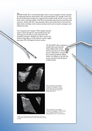 Lt0184 a double bundle acl | PDF