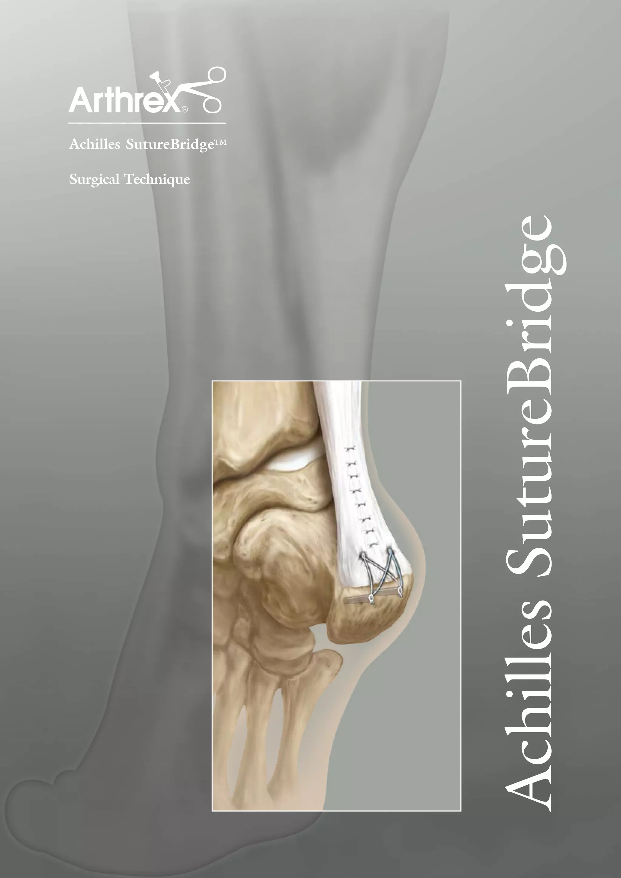 Lt0460 b achilles suturebridge | PDF