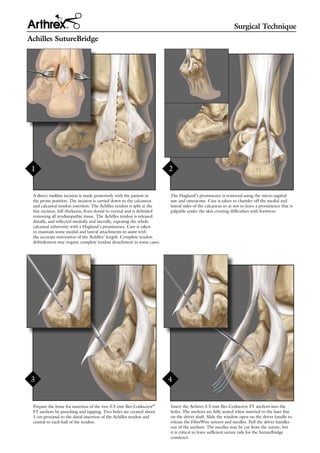 Lt0460 b achilles suturebridge | PDF