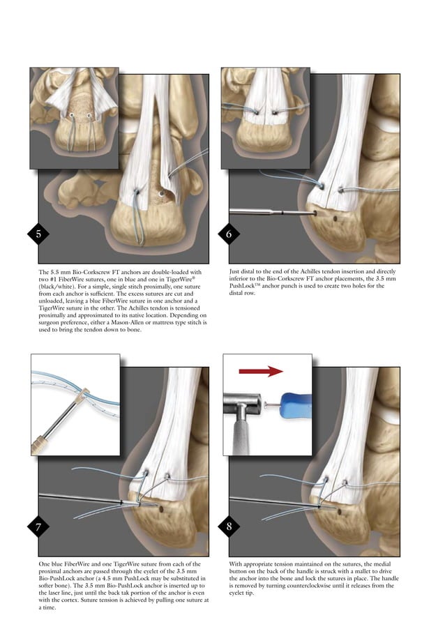 Lt0460 b achilles suturebridge | PDF | Foot Health | Diseases and ...