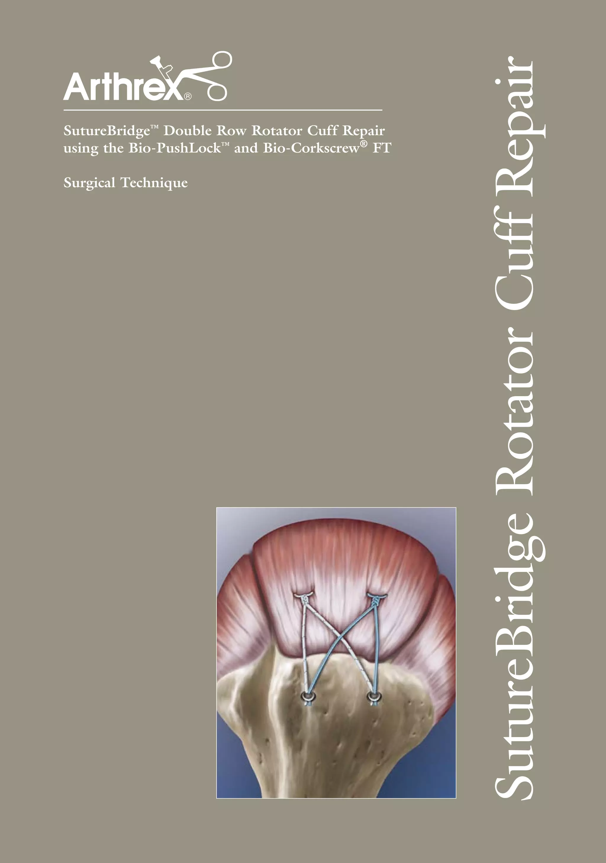 Lt0515 d suturebridge | PDF