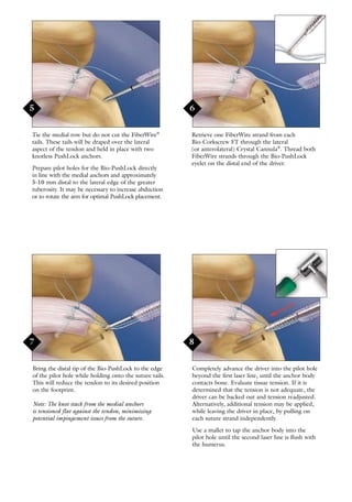 Lt0515 d suturebridge | PDF