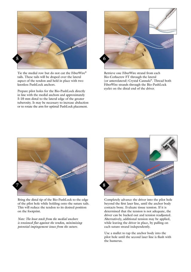 Lt0515 d suturebridge | PDF