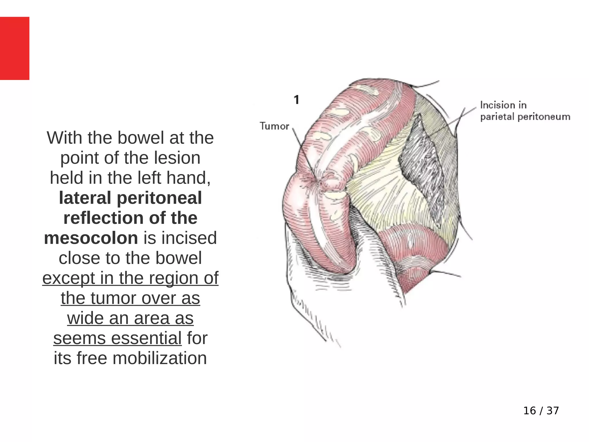 Lt hemicolectomy - Surgical Approach, Complications. | PDF