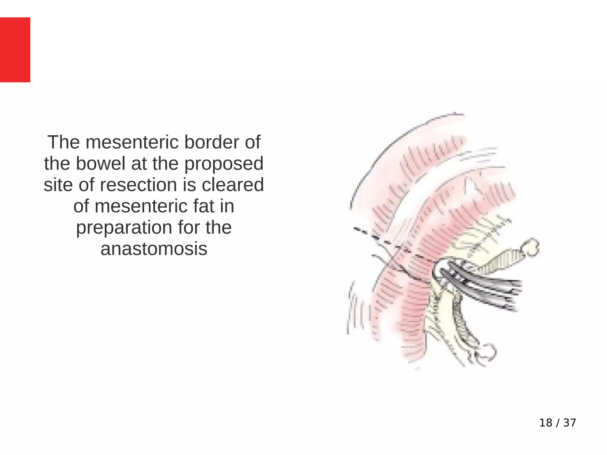 Lt hemicolectomy - Surgical Approach, Complications. | PDF