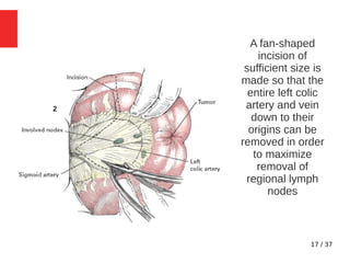 Lt hemicolectomy - Surgical Approach, Complications. | PDF